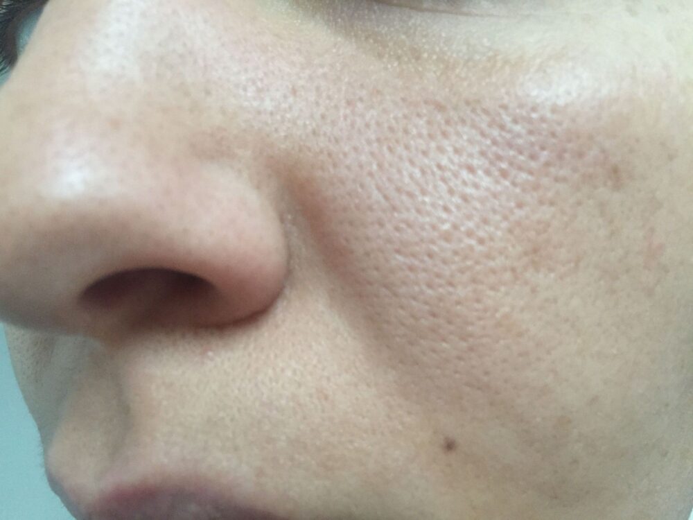 Pores dilatés : définition, causes et traitements pour les resserrer