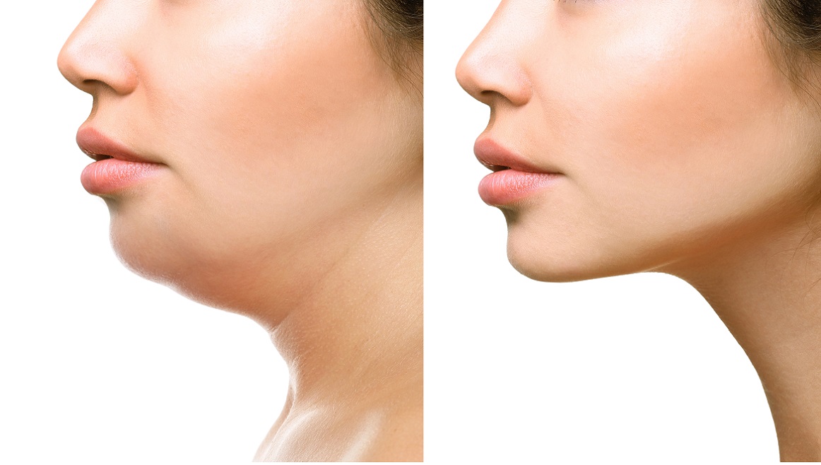Le menton fuyant : pas seulement un problème esthétique du visage