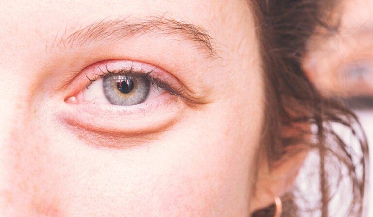 Poches sous les yeux : causes et traitements naturels