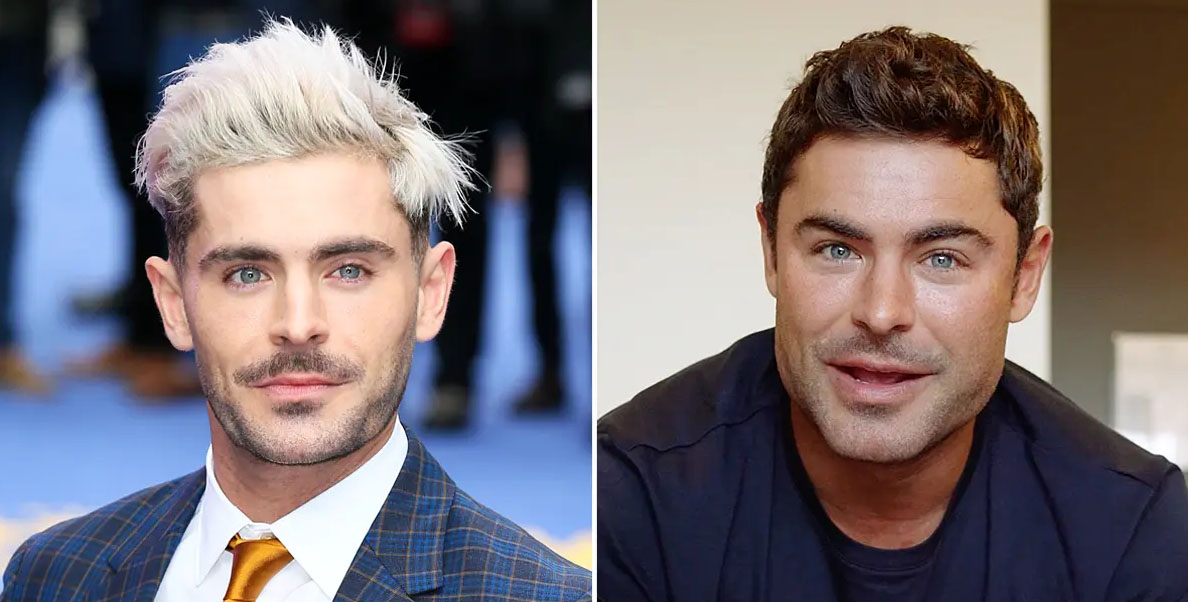 Zac Efron Visage Est Ce Leffet Dune Chirurgie Esthétique