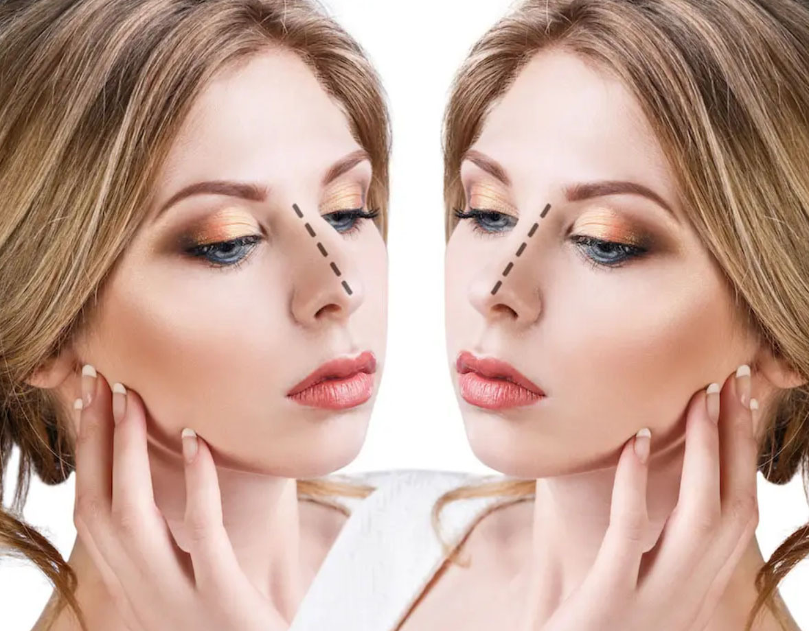 Comment choisir la forme et taille de nez lors d'une rhinoplastie