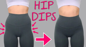 Hip Dips Op Vorher Nachher